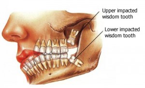 What Happens If You Don’t Get Your Wisdom Teeth Removed? Austin Oral ...